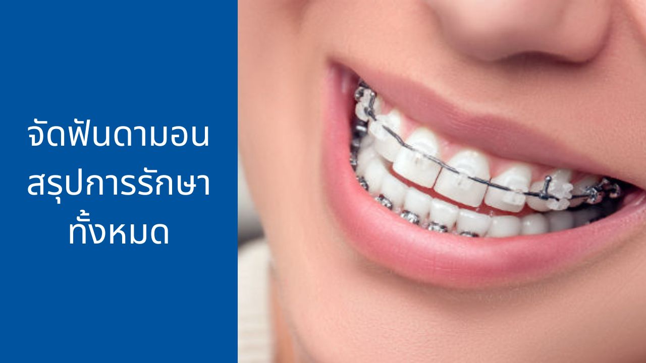 จัดฟันดามอน (Damon) คืออะไร พร้อมข้อดี-ข้อเสียของการจัดฟันแบบนี้